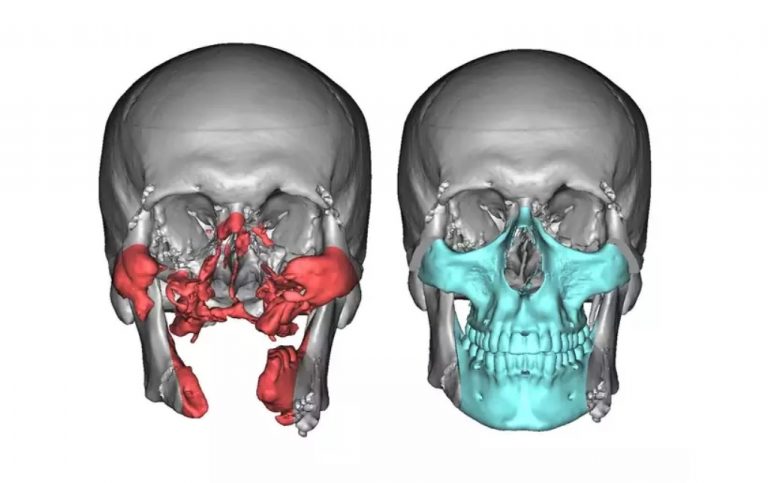 3D Printing Technology Revolutionazing Face Transplant